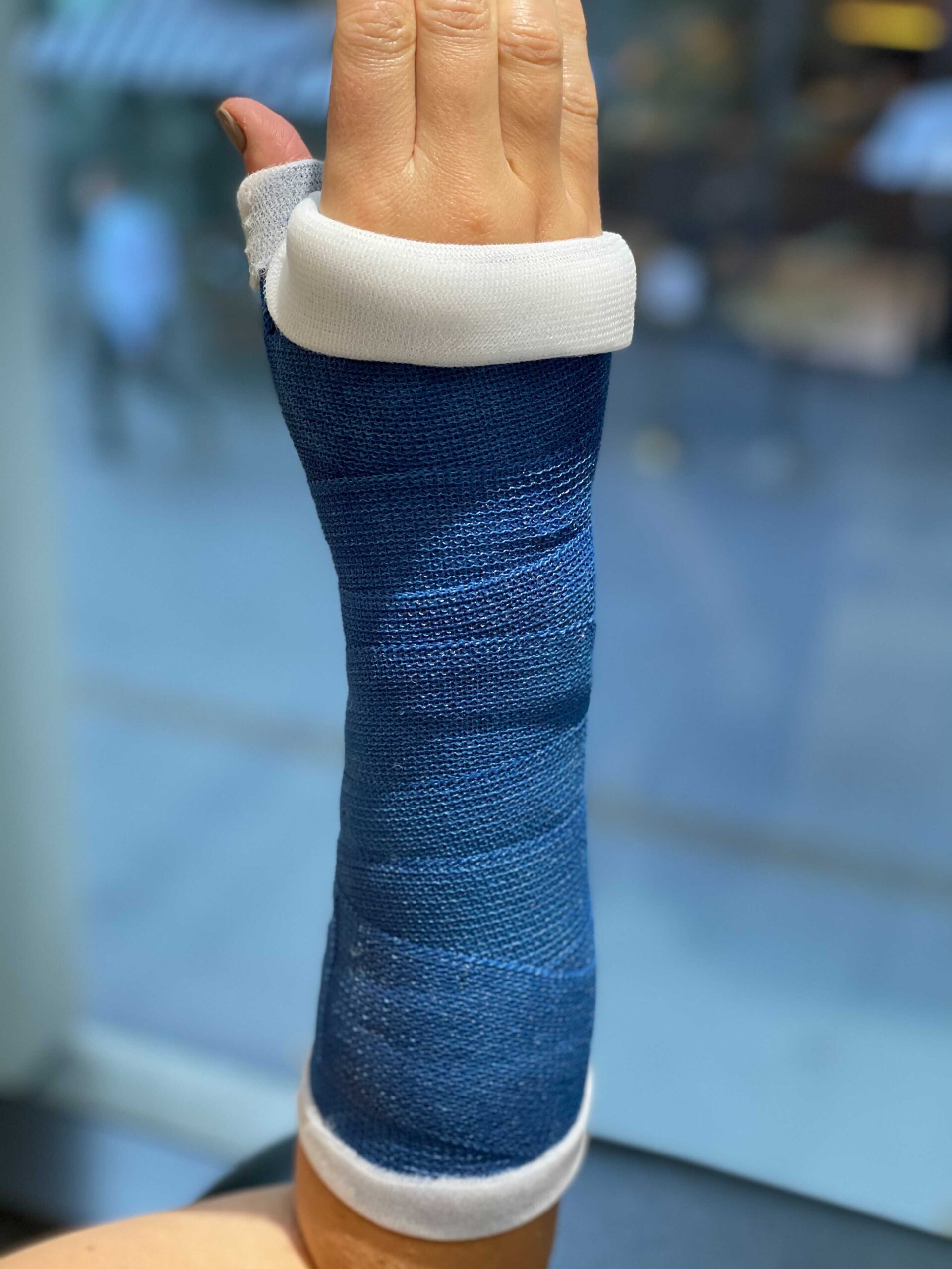 Casting - Barangaroo Physio | Upper Limb Casting Services