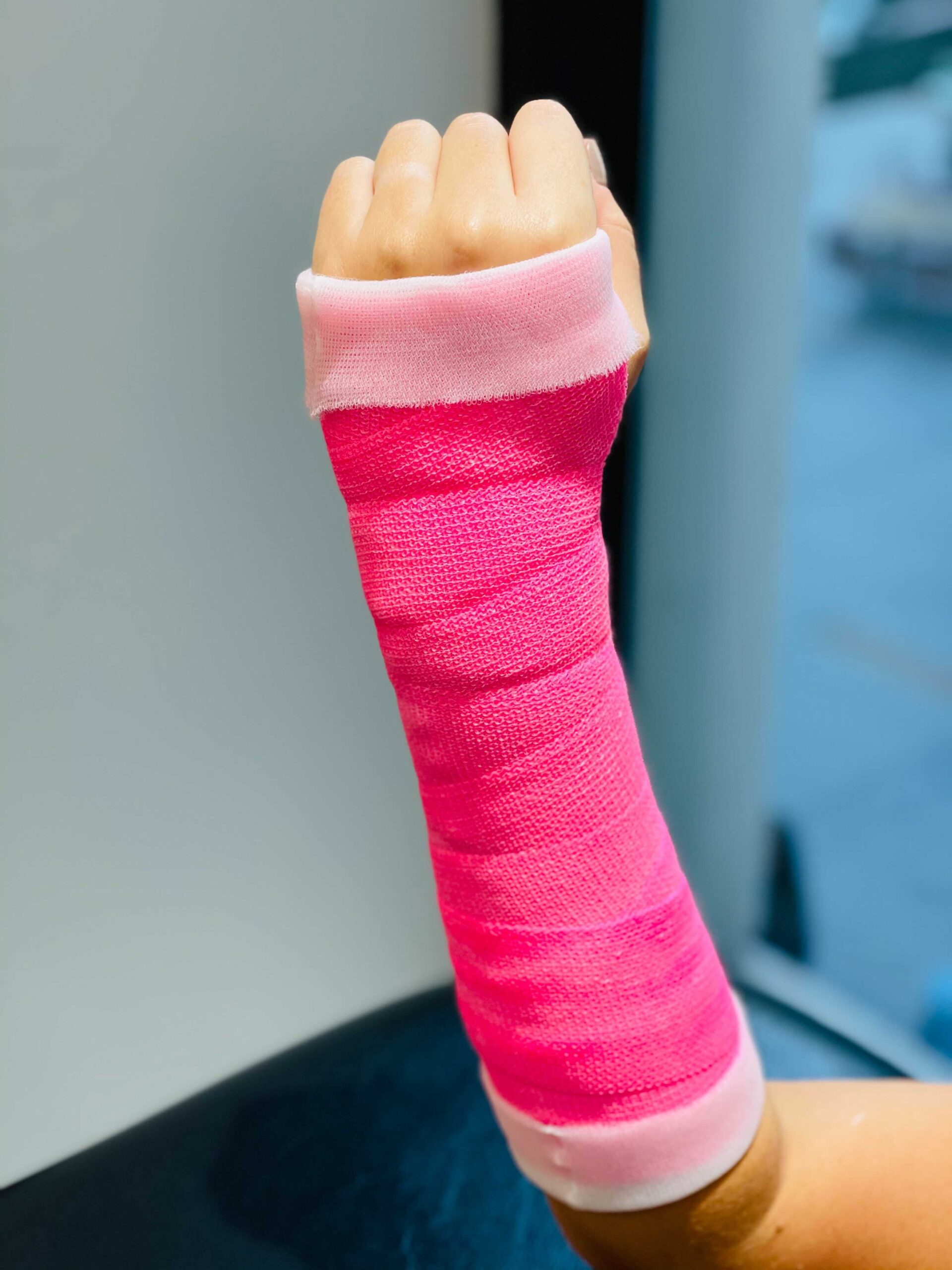 Casting - Barangaroo Physio | Upper Limb Casting Services